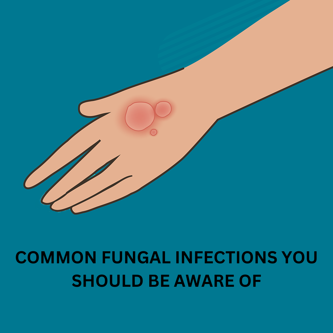 COMMON FUNGAL INFECTIONS YOU SHOULD BE AWARE OF - onlinegenericmedicine